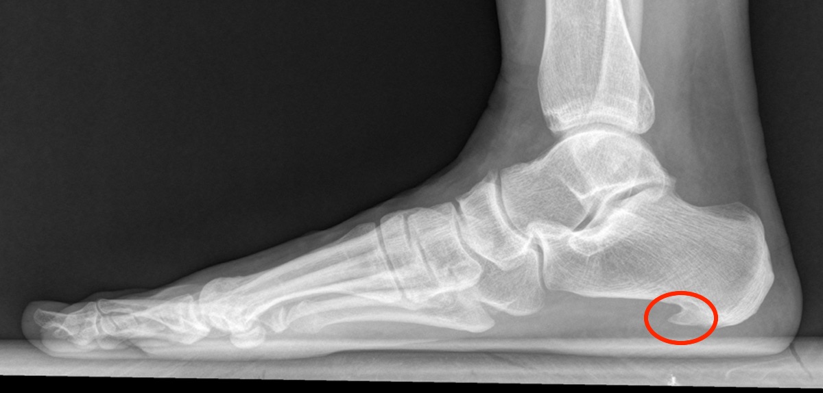 Wandelen en hielspoor: wat je er (niet) aan kunt doen | Kampeerwijzer